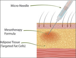 mesotherapy treatment at our dermatologists office in Charlotte ...